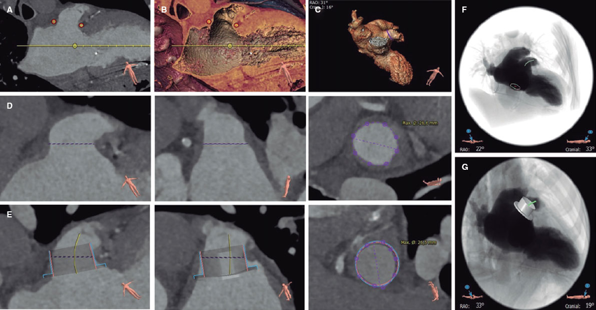 Role of computed tomography in transcatheter coronary and structural ...