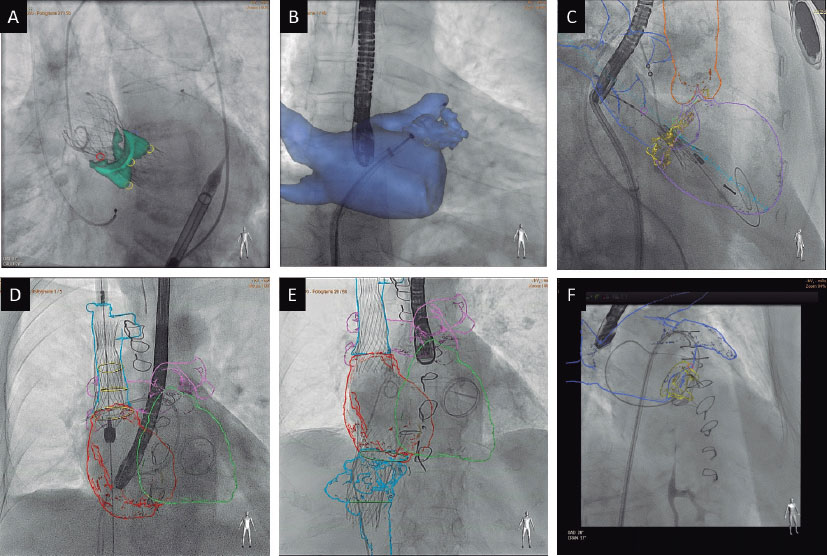 Role of computed tomography in transcatheter coronary and structural heart disease interventions