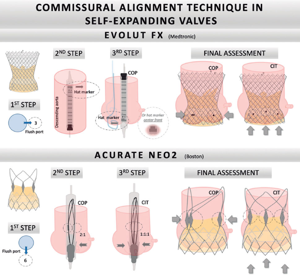 The role of implant projection in optimizing transcatheter aortic valve ...