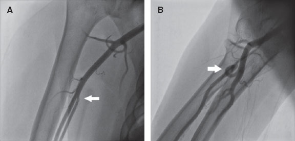 Incidence and predictors of radial artery occlusion following ...