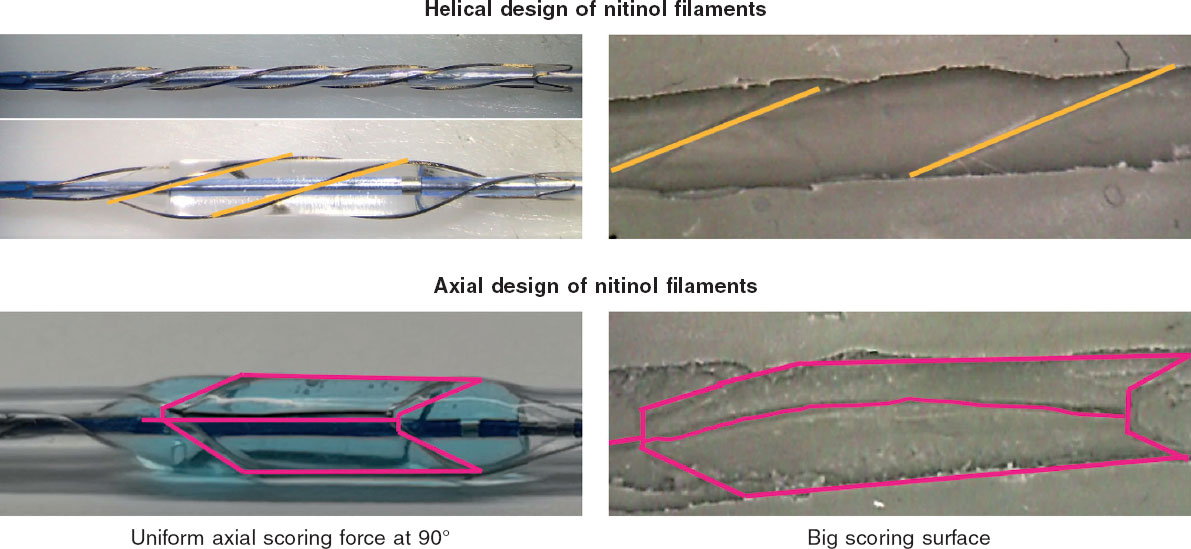 New scoring balloon to treat moderate-to-severe calcified coronary ...