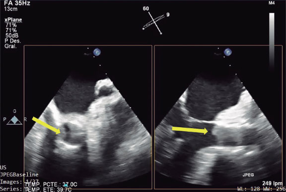 Infectious endocarditis on percutaneous aortic valve prosthesis ...