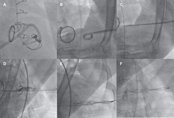 Percutaneous closure of left ventricular puncture after thoracentesis