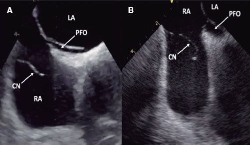 Chiari network. A potential enemy in patent foramen ovale closure