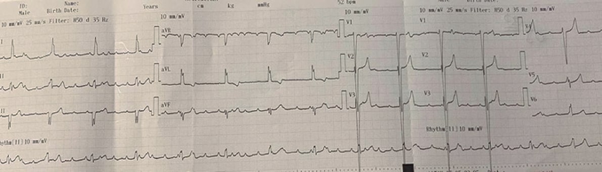 Heart block after transcatheter septal defect closure in infants under ...