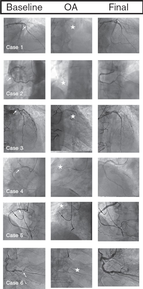 Feasibility and safety of orbital atherectomy in uncrossable lesions