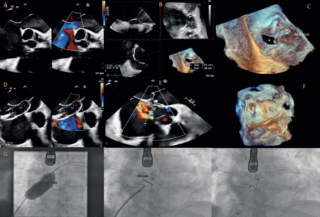 Atrial septal defect closure with cor triatriatum sinister