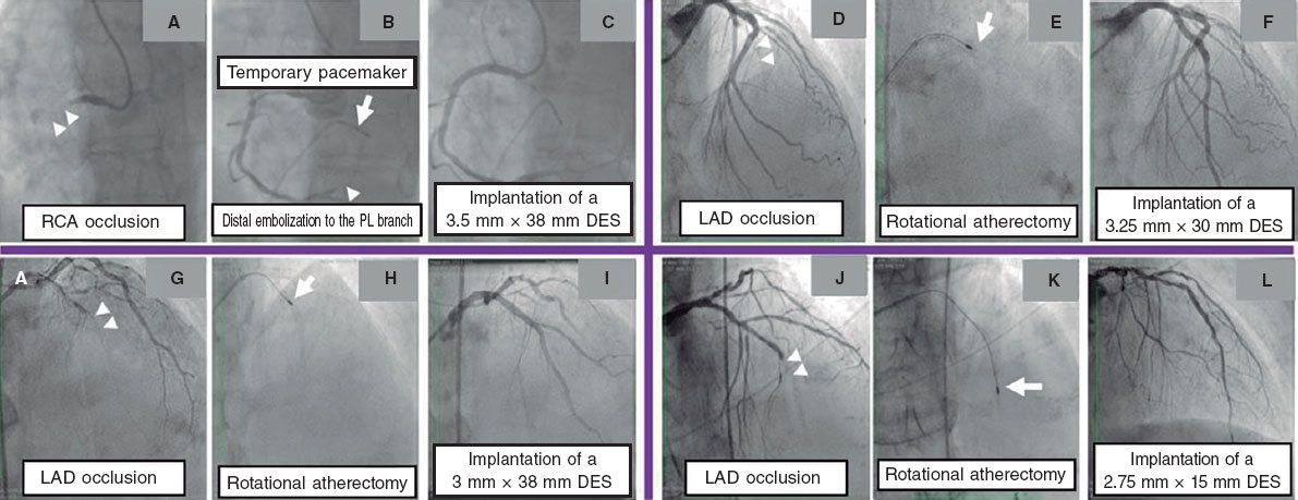 Off-label use of rotational atherectomy in STEMI: a single-center ...